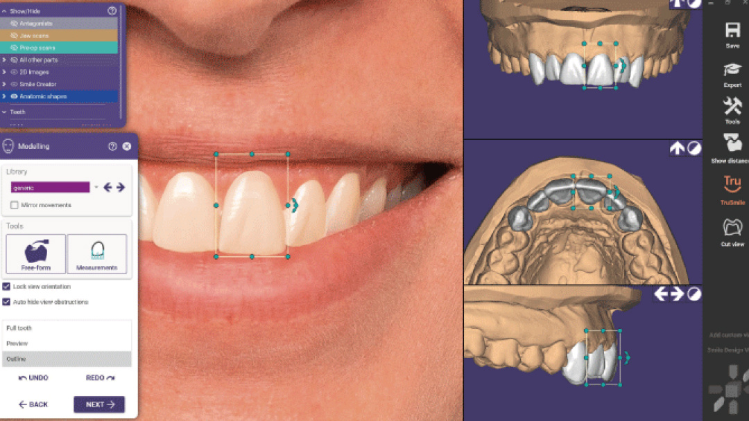 Exocad Dental Implant Planning Software | MyRay