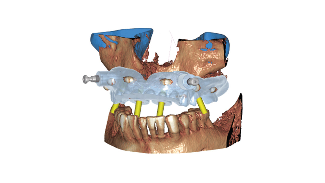 Software per Progettazione Impianti Dentali Exocad | MyRay
